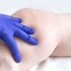 Flebite o que é: entenda os sintomas, causas e tratamentos