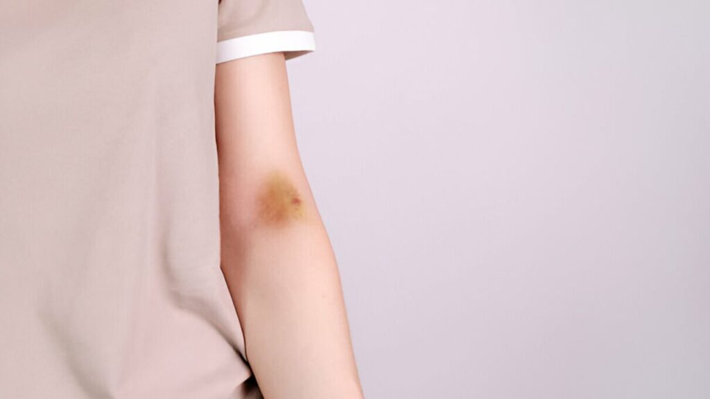 Flebite o que é: entenda os sintomas, causas e tratamentos