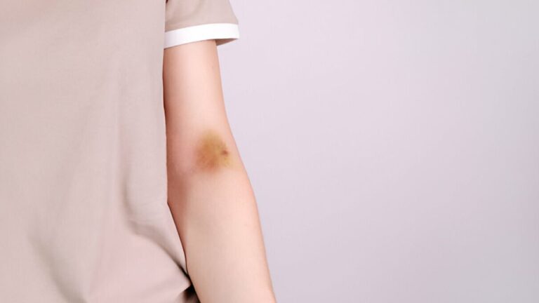 Flebite o que é: entenda os sintomas, causas e tratamentos