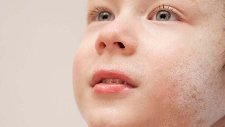 Mancha branca no rosto: entenda o que pode ser!