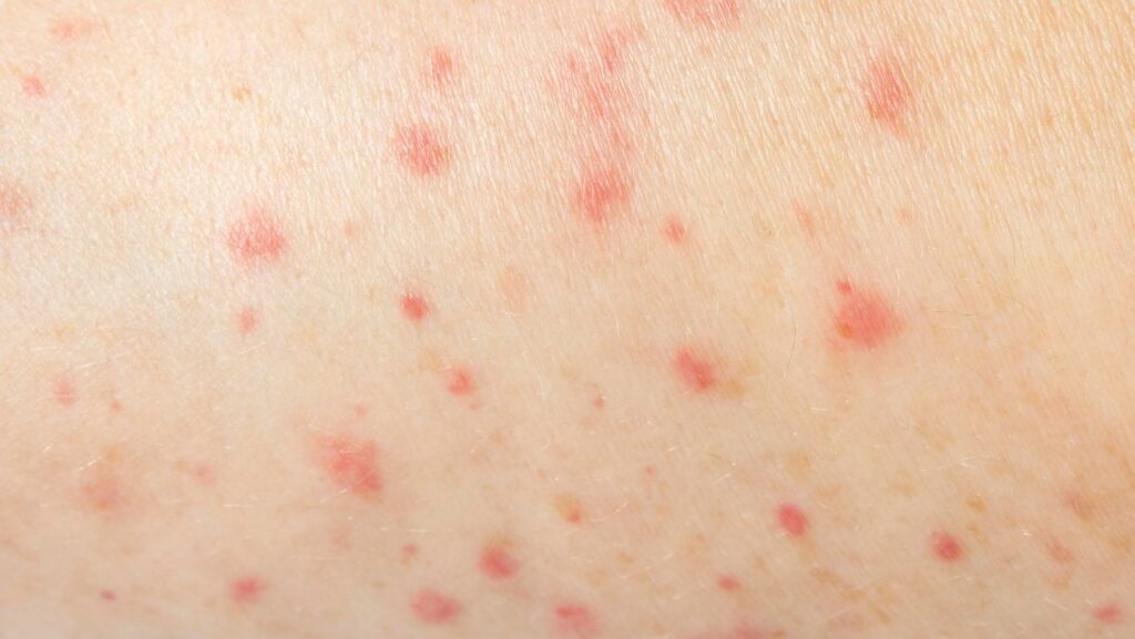 O que é foliculite na virilha? Entenda tudo sobre!