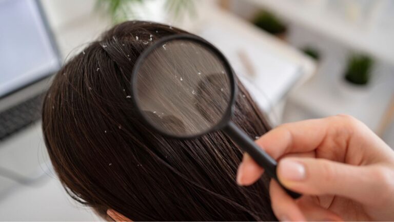 O que é caspa: causas, tipos, tratamentos e prevenção