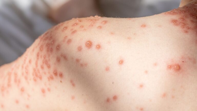 Sintomas de catapora: o que surge primeiro, duração e tratamento