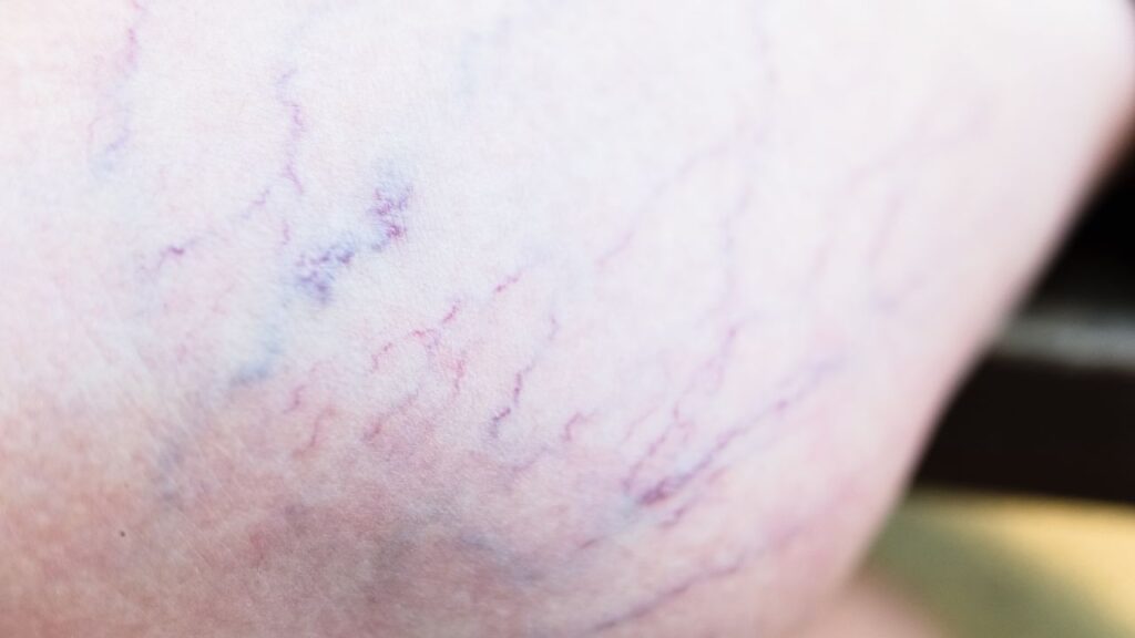 O que causa varizes: principais fatores, riscos e prevenção